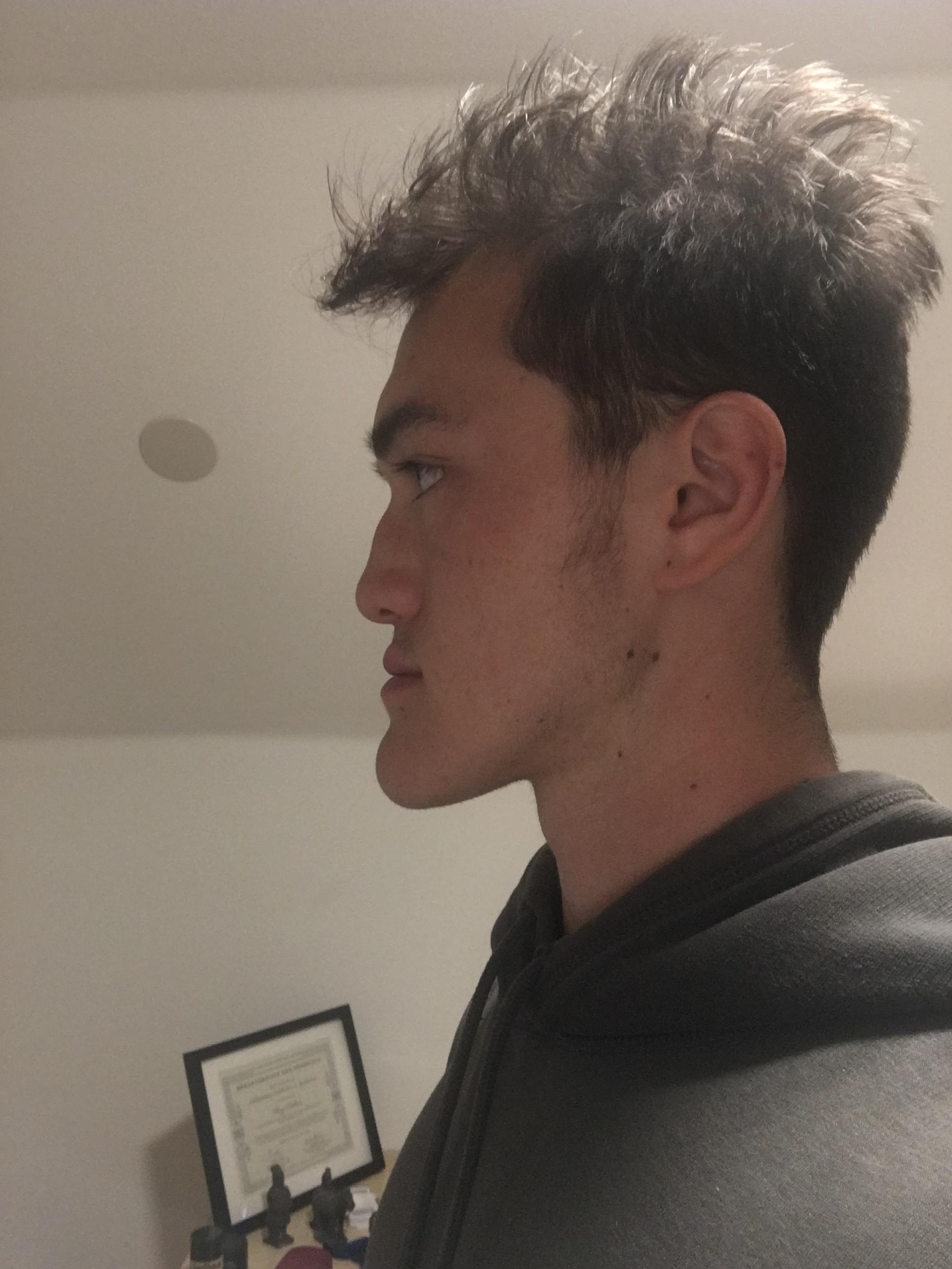 How do I Fix Mandibular Prognathism, a Recessed Maxilla, and underbite ...