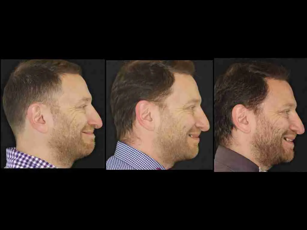 Fixed Anterior Growth Guidance Appliance (FAGGA) – Holy Grail? Gonial ...